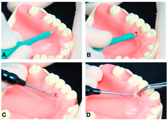 A Minimally Invasive Surgical Procedure to Harvest Palate Periosteum as ...