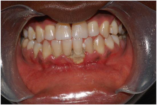 Iron Deficiency Anemia and Its Impact on Oral Health—A Literature Review