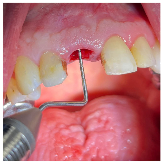 Minimally Invasive Extraction System Benex—Clinical Evaluation and ...