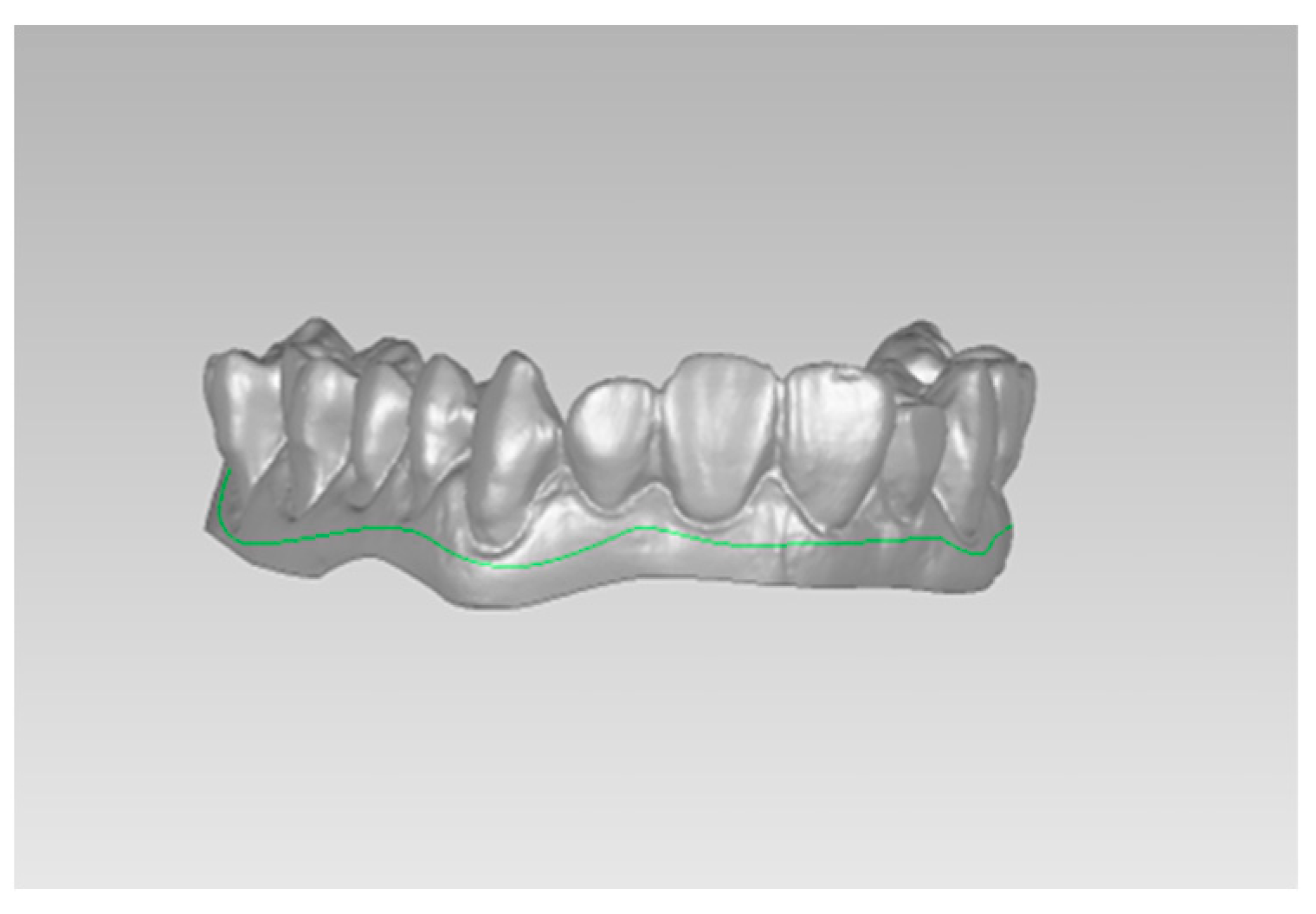 Assessing the Impact of IOS Scanning Accuracy on Additively ...