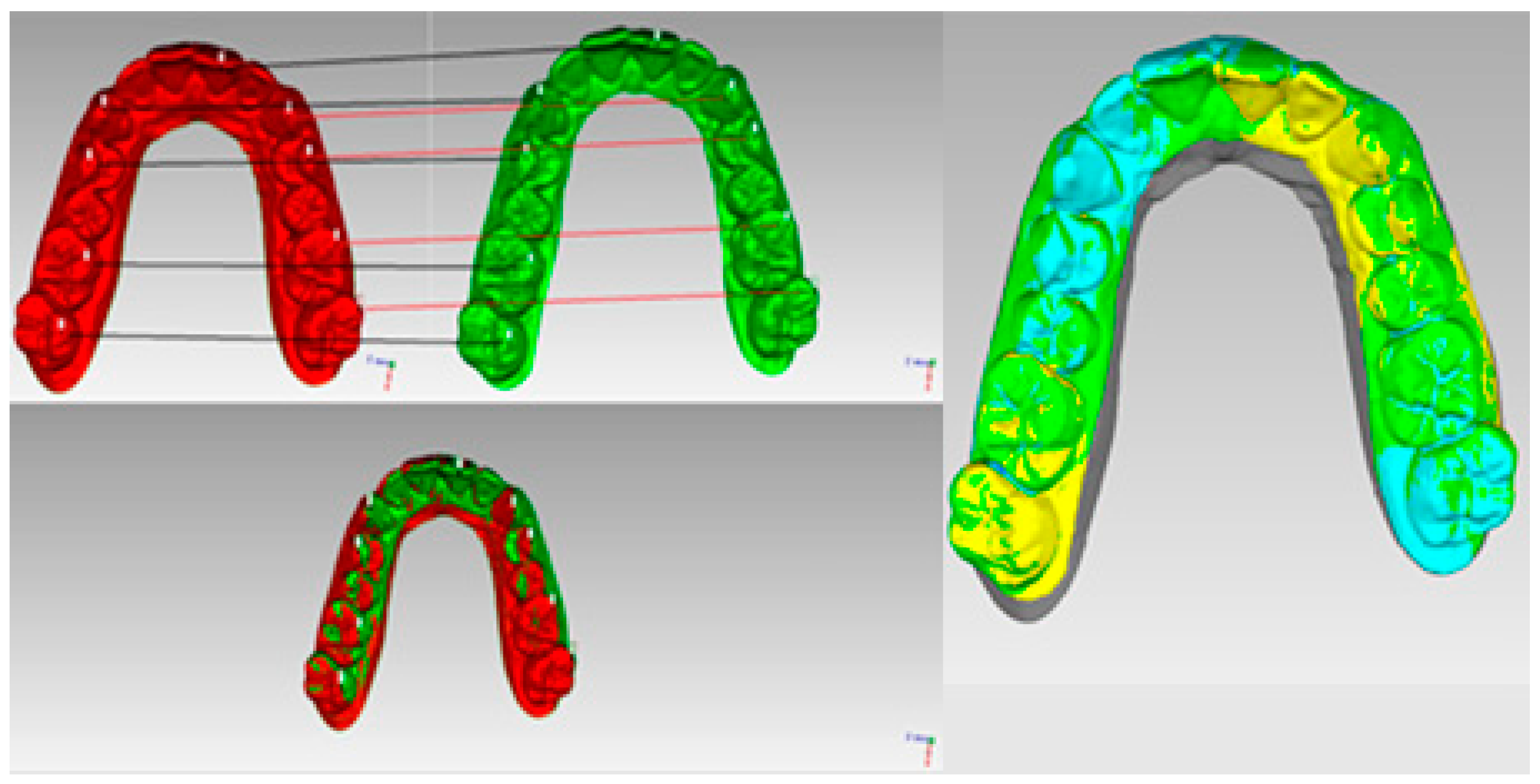 Assessing the Impact of IOS Scanning Accuracy on Additively ...