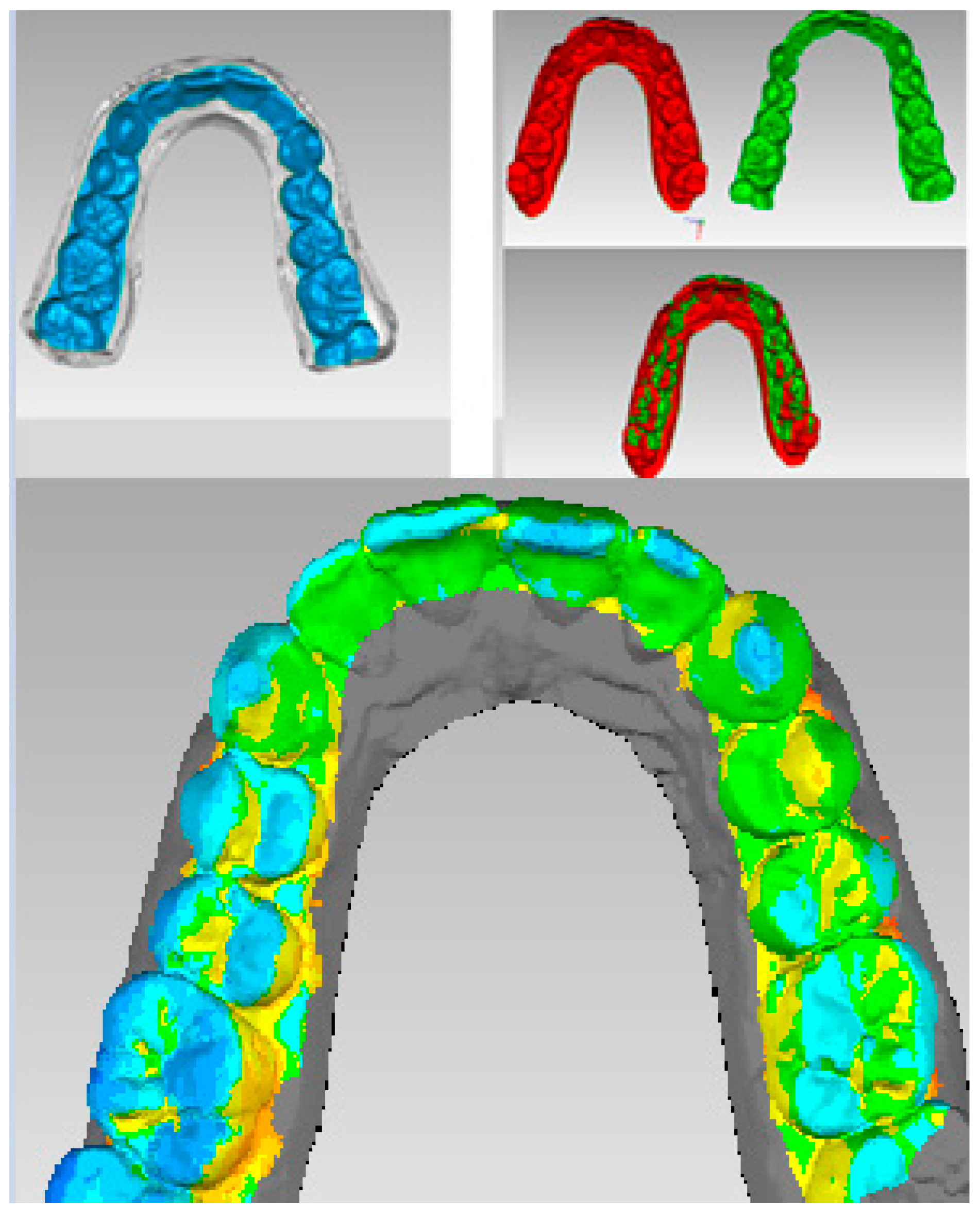 Assessing the Impact of IOS Scanning Accuracy on Additively ...