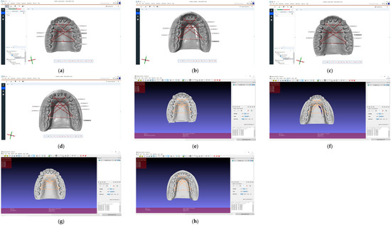 An Evaluation of the Accuracy of Digital Models—An In Vitro Study