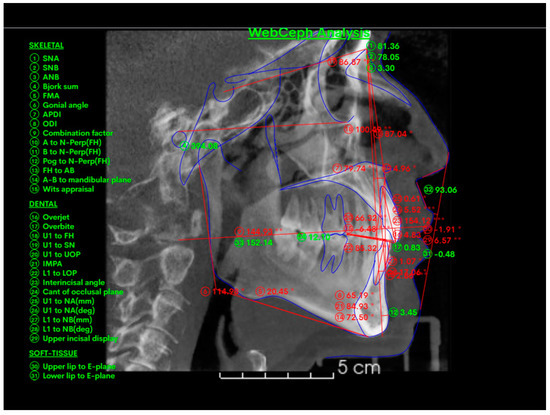 Characteristics of the Occlusal Plane Associated with Unilateral and ...