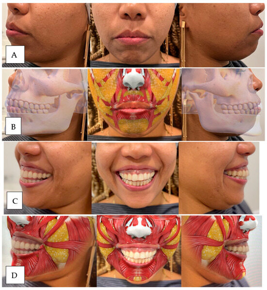 Proposal of a New Therapeutic Classification in Gingival Smiles Focused ...