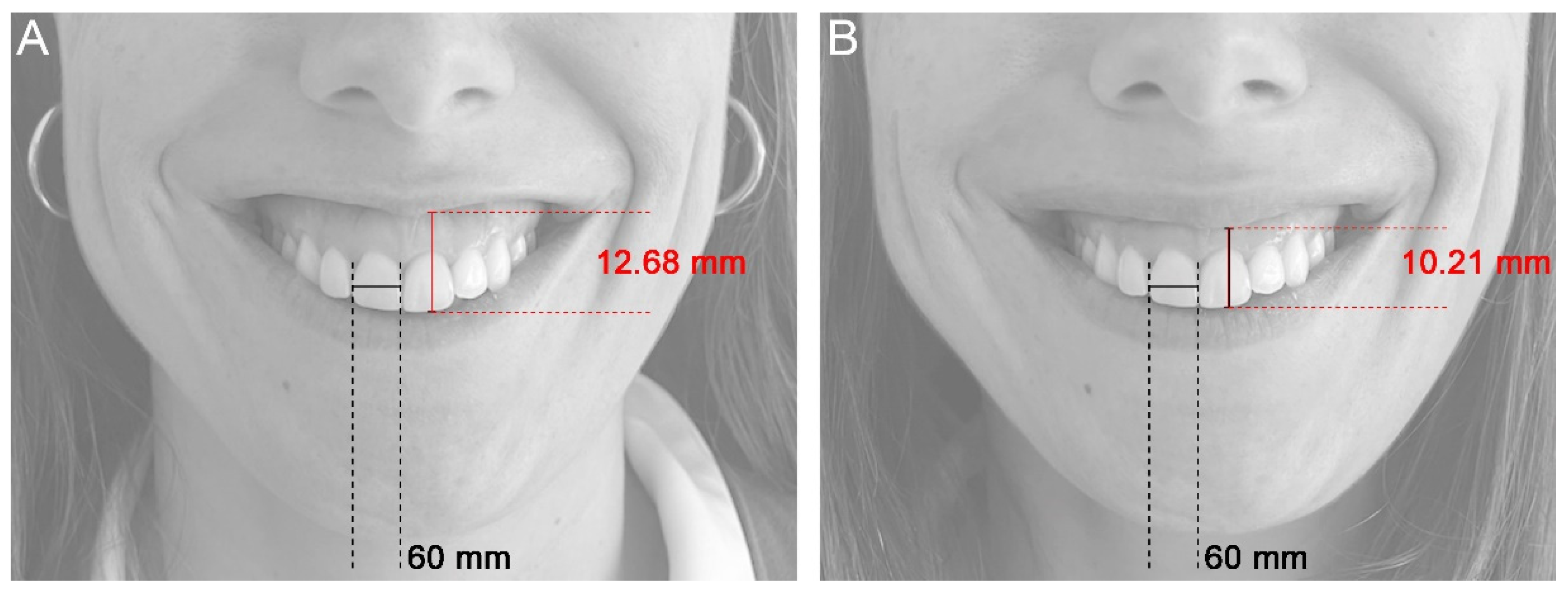 Evaluation of a New Technique of Gingival Smile Reduction after ...