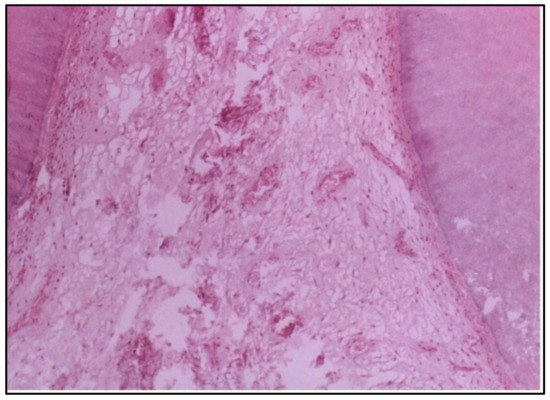 Histological Evaluation of Polyacid-Modified Composite Resin and ...