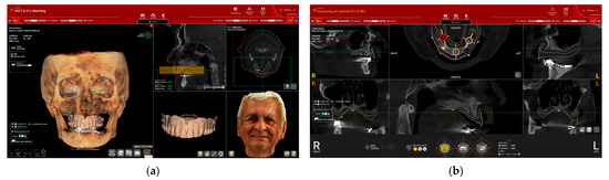Predictable Full Digital Workflow Using Stackable Surgical Templates ...