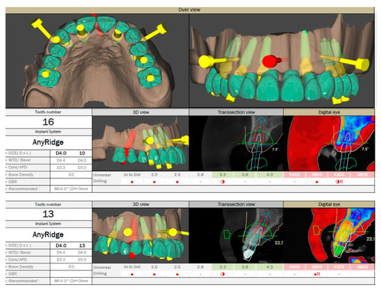 Predictable Full Digital Workflow Using Stackable Surgical Templates ...