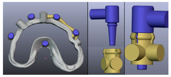 Predictable Full Digital Workflow Using Stackable Surgical Templates ...
