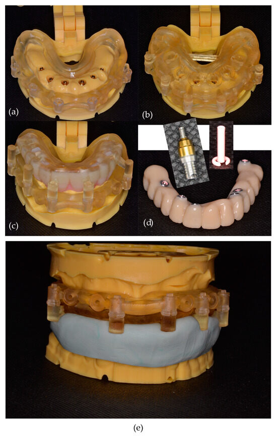 Predictable Full Digital Workflow Using Stackable Surgical Templates ...