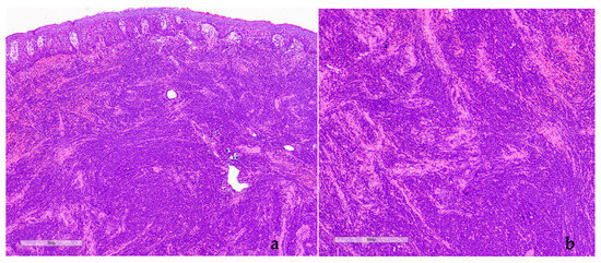 Challenges in Differential Diagnosis of Diffuse Gingival Enlargement ...