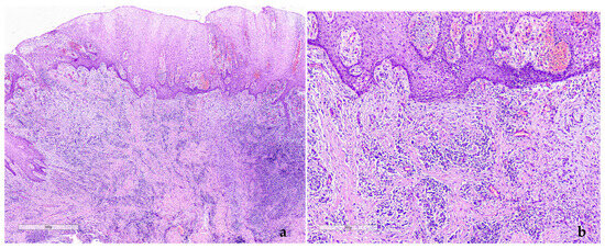 Challenges in Differential Diagnosis of Diffuse Gingival Enlargement ...