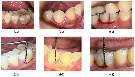 Clinical and Radiographic Parameters for Early Periodontitis Diagnosis ...
