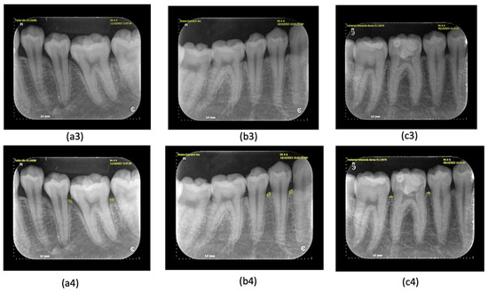 Clinical and Radiographic Parameters for Early Periodontitis Diagnosis ...