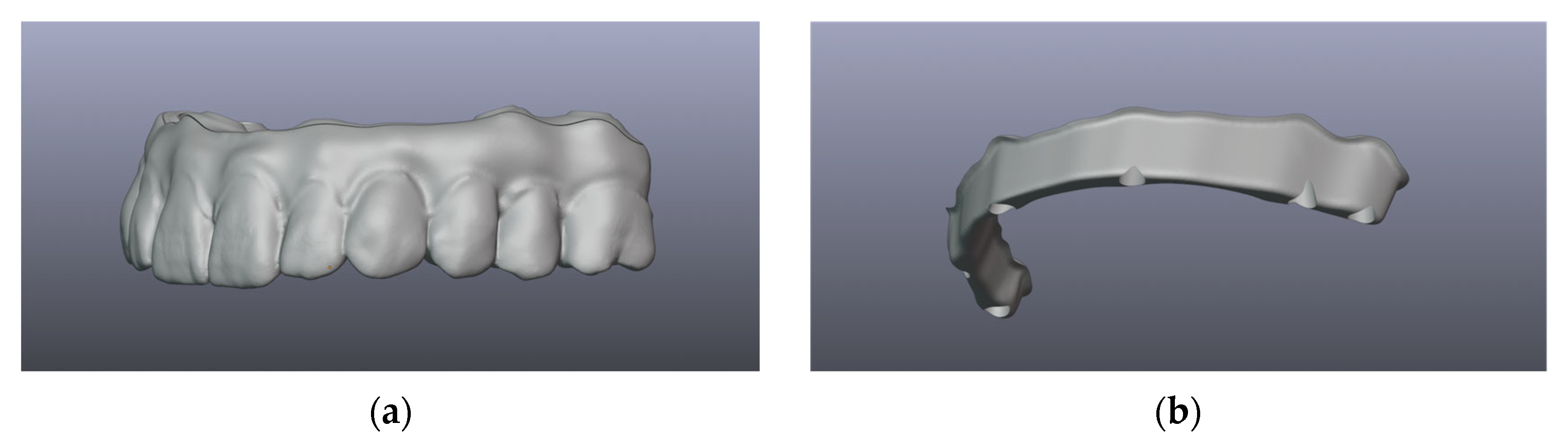 Fixed Full-Arch Implant-Supported Restorations: Techniques Review and Proposal for Improvement