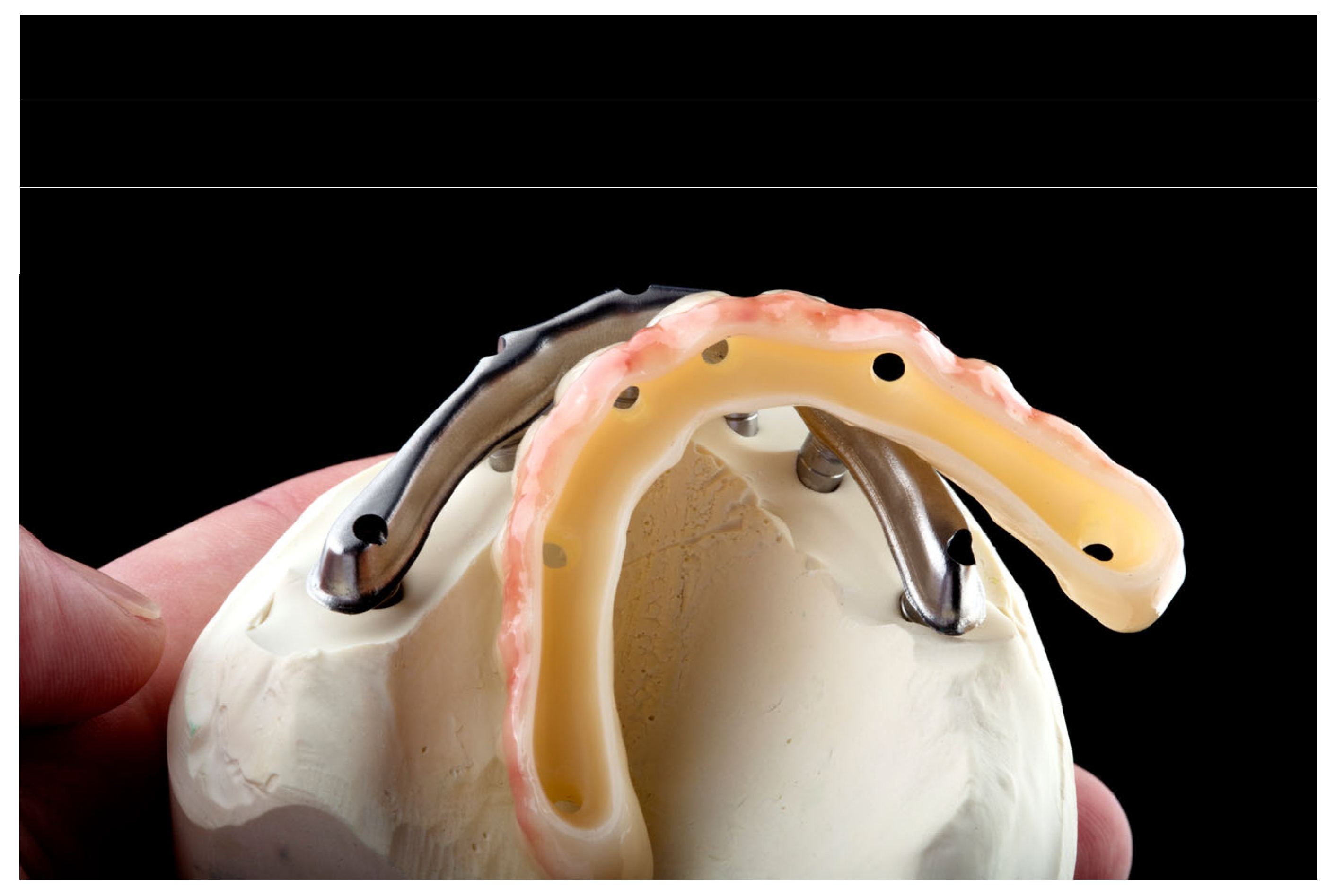 Fixed Full-Arch Implant-Supported Restorations: Techniques Review and ...