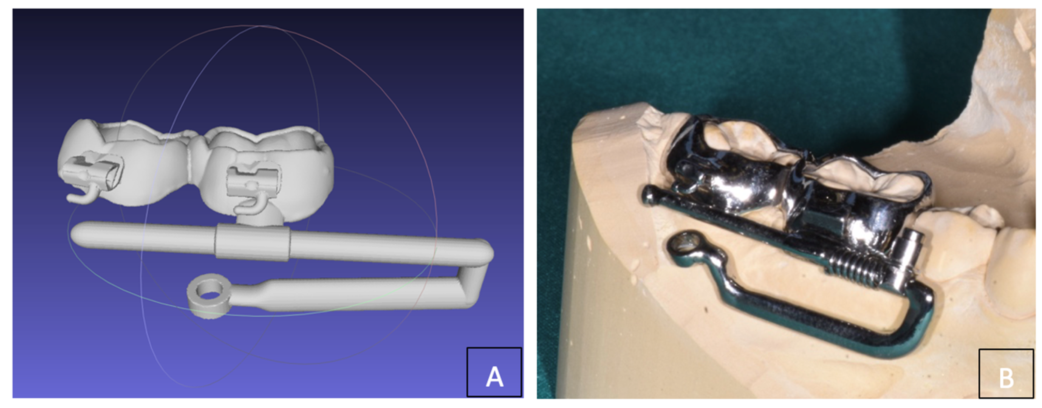 Application of CAD-CAM 3D Technology in Designing a Molar Distalization ...