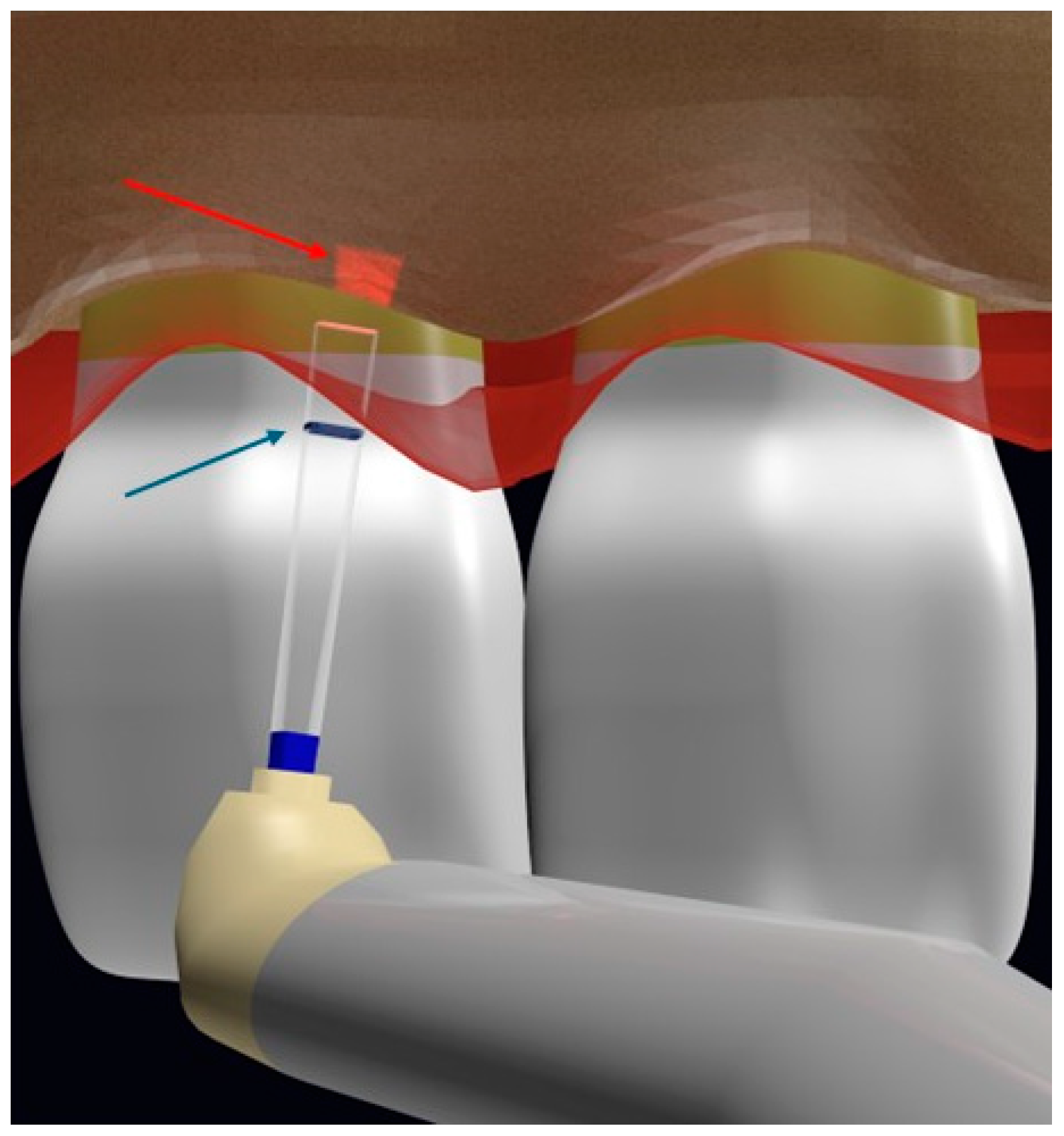 Outcomes of Flapless Er:YAG and Er,Cr:YSGG Laser-Assisted Crown Lengthening: A Systematic Review