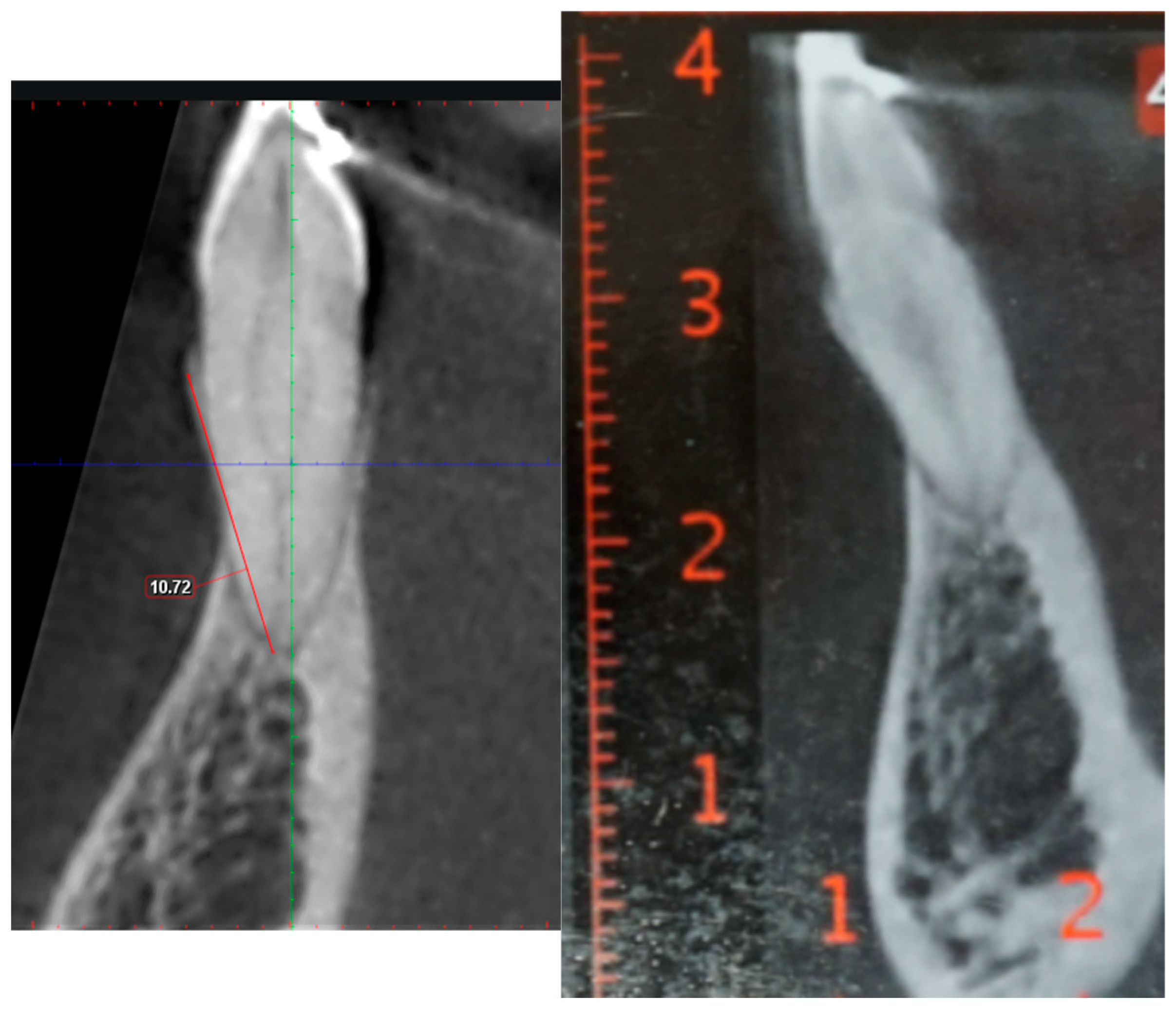 Can Viewing Modality Affect Frontal Mandibular Bone Height Measurement ...