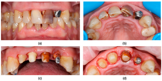 Immediate Patient Satisfaction with Dental Esthetics After Endodontic ...