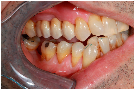 Immediate Patient Satisfaction with Dental Esthetics After Endodontic ...