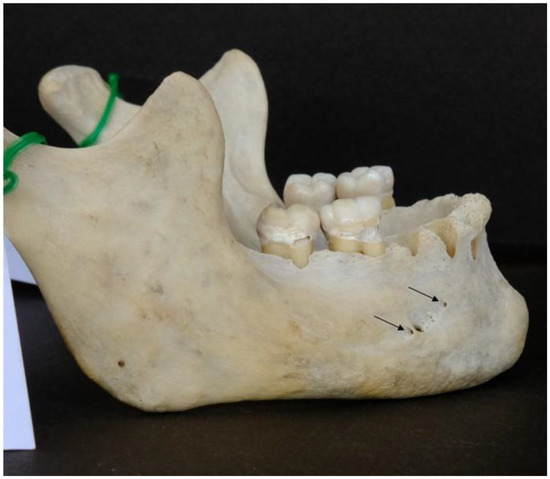 Accessory Mental Foramina in Dry Mandibles: An Observational Study ...