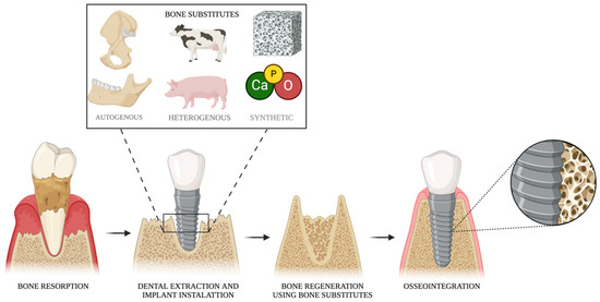 Biomaterials for Guided Tissue Regeneration and Guided Bone ...