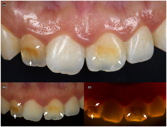 Micro- and Macroabrasion in the Esthetic Zone: A Narrative Review and ...