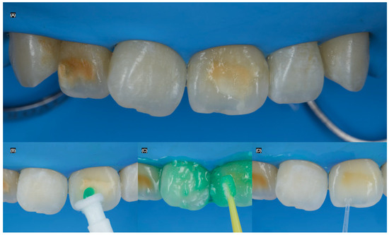 Micro- and Macroabrasion in the Esthetic Zone: A Narrative Review and ...