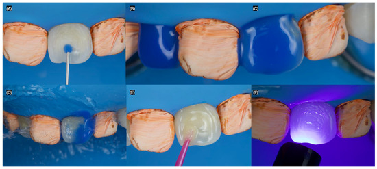Micro- and Macroabrasion in the Esthetic Zone: A Narrative Review and ...
