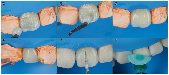 Micro- and Macroabrasion in the Esthetic Zone: A Narrative Review and ...