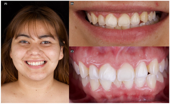 Micro- and Macroabrasion in the Esthetic Zone: A Narrative Review and ...