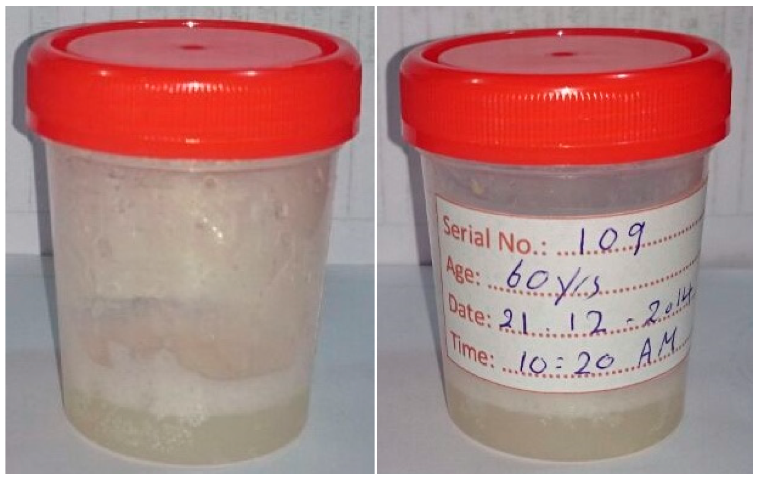 Comparative Analysis of Salivary Tumor Marker CA-125 Among Oral ...