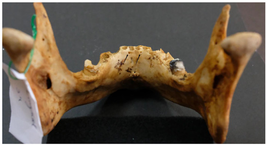 Lingual Foramina Anatomy: An Observational Study in Dry Mandibles