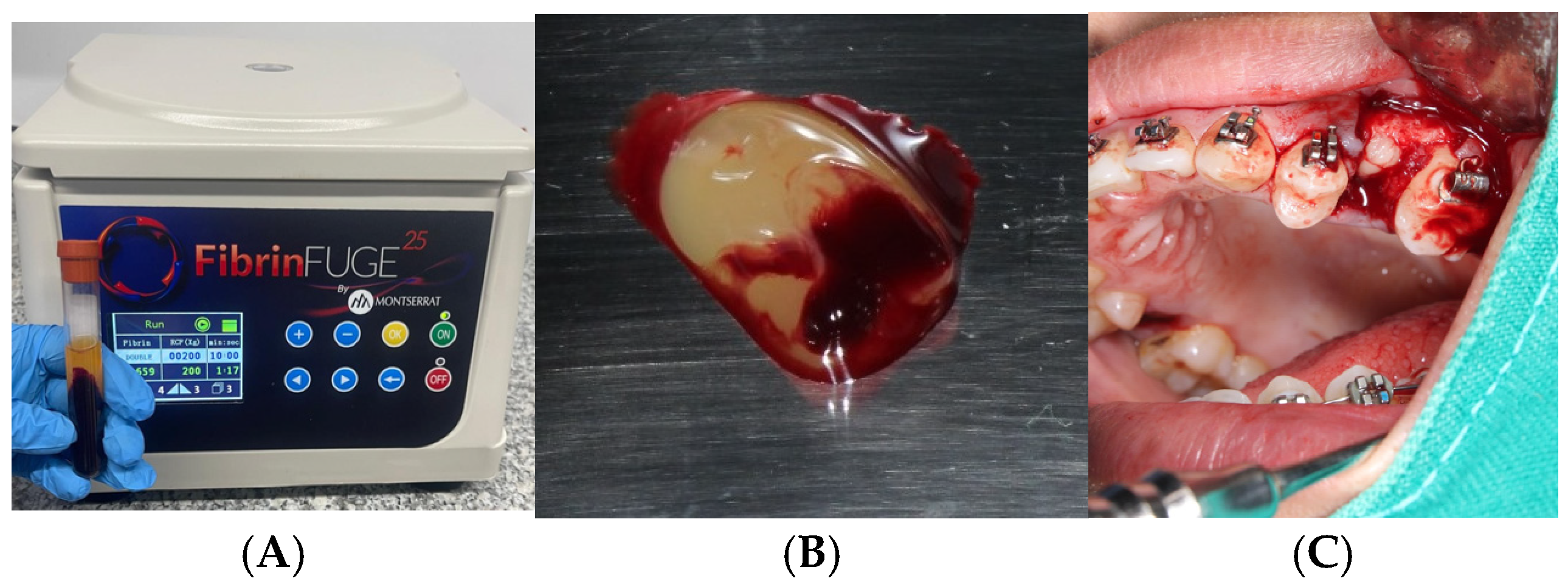 Radiographic Evaluation in Alveolar Preservation Using Platelet-Rich ...