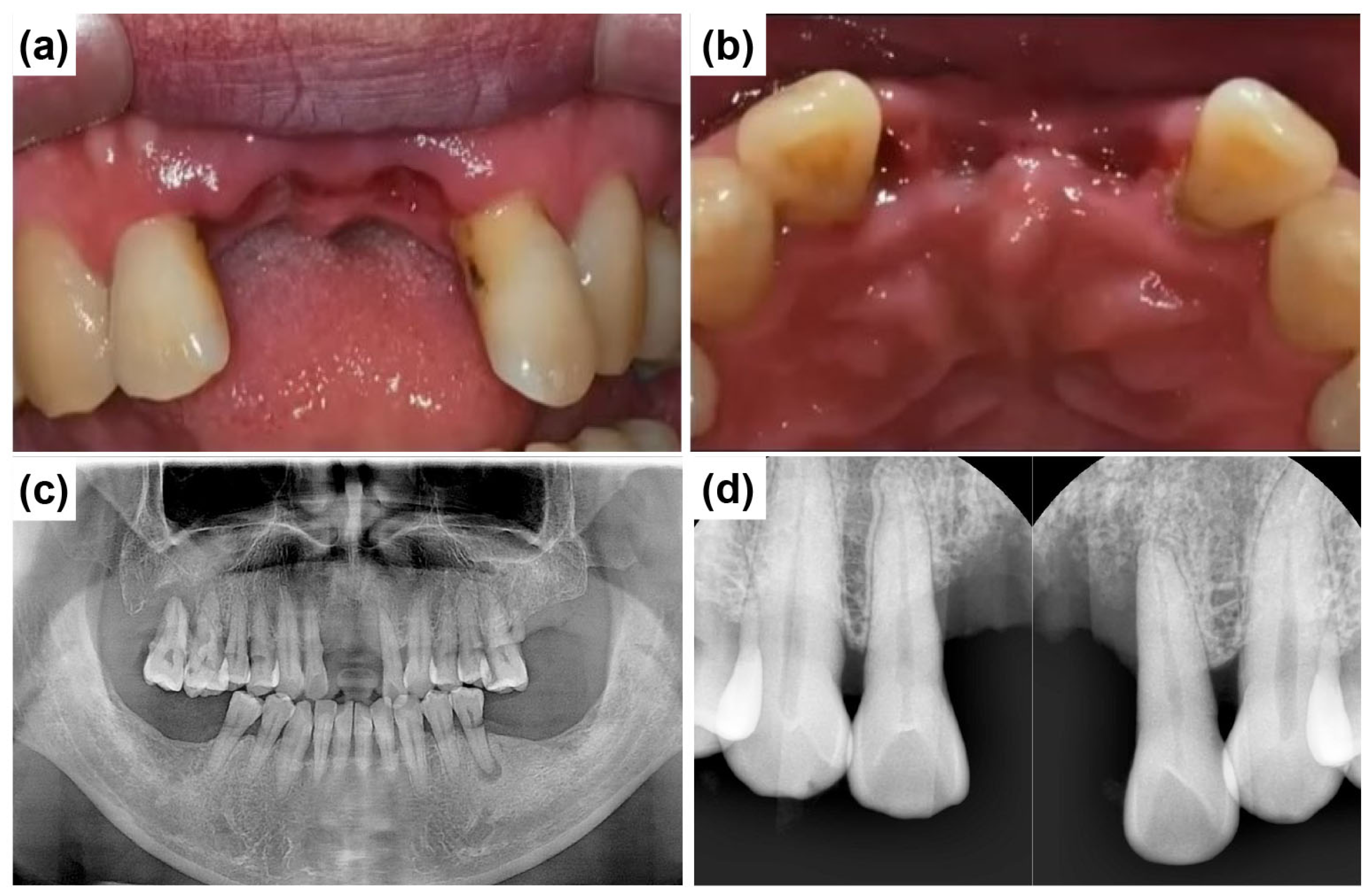 The Clinical Application of the ARi® Implant System in Severely ...