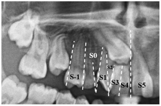 Transposed Maxillary Canines: Narrative Review with Clinical Case Report
