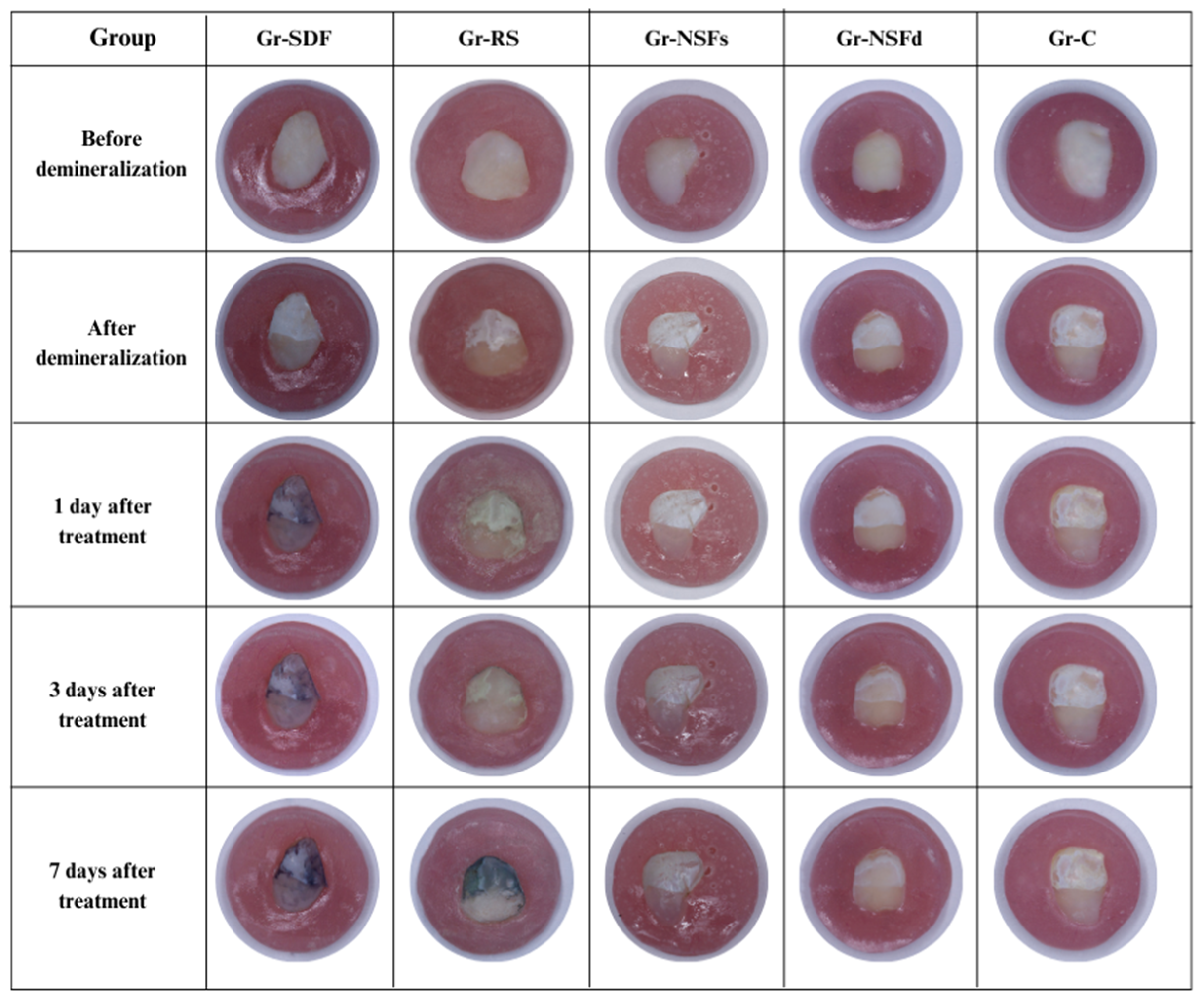 Green-Synthesized Nano-Silver Fluoride for Remineralization of Enamel ...