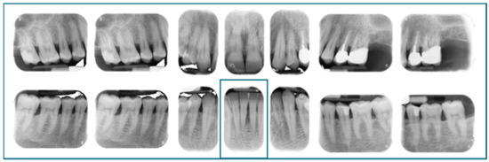 The 2018 Classification of Periodontitis: Challenges from Clinical ...