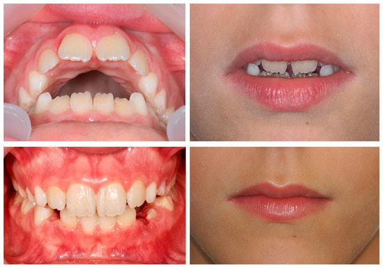 Retrospective Evaluation of Invisalign® Mandibular Advancement in ...