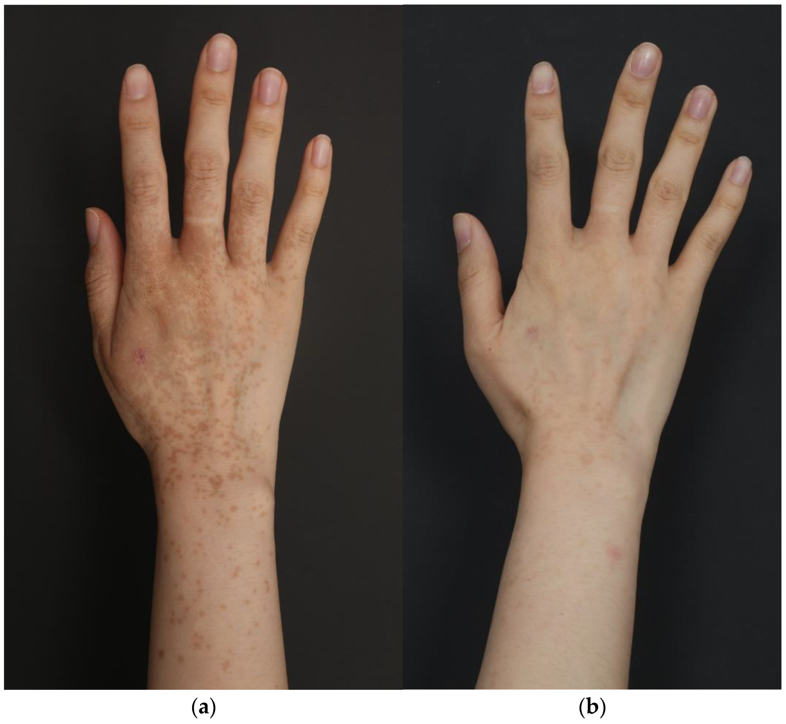 Hyperpigmentation Hands