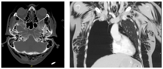A 63-Year-Old Female Presenting to the Emergency Department with ...