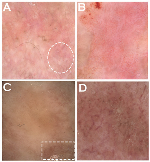 Cutaneous Squamous Cell Carcinoma: An Up-to-Date Comprehensive Review ...