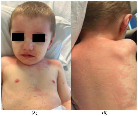 What Does Herpes Look Like On A Baby - Infoupdate.org
