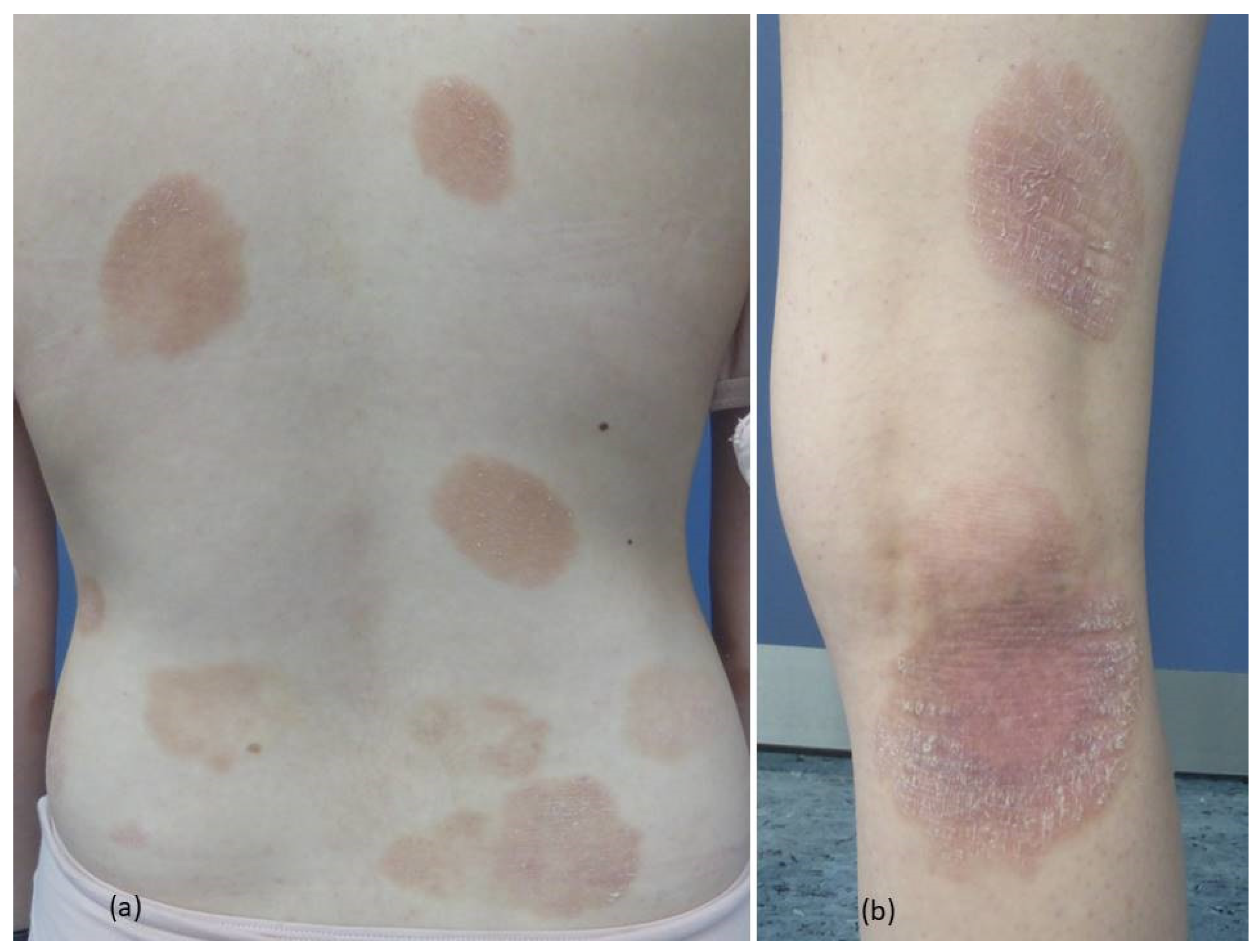 Juvenile-Onset Non-Poikilodermatous CD8+CD56+ Mycosis Fungoides