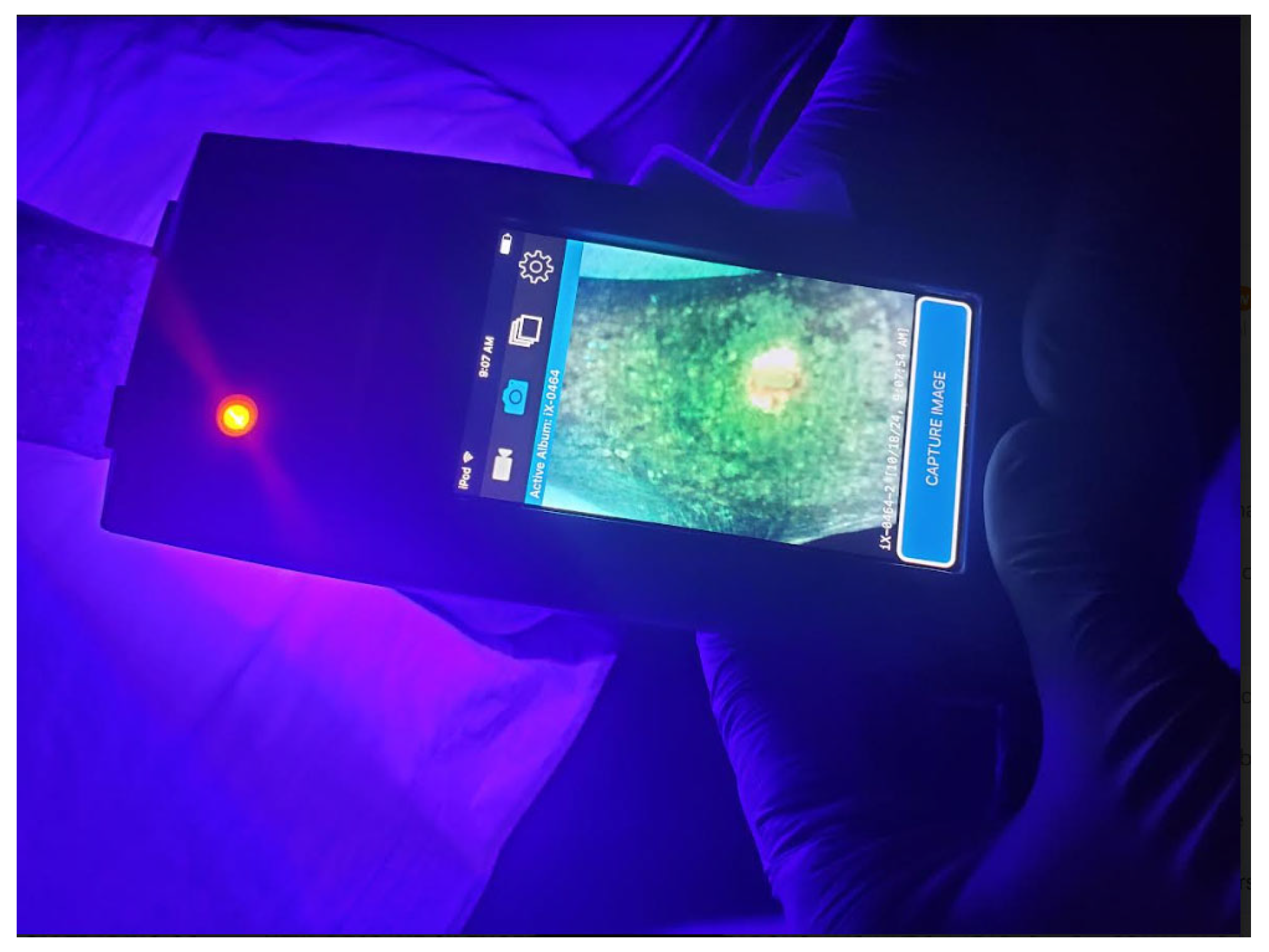 Henoch-Schönlein Purpura (IgA Vasculitis) Chronic Lesions: How ...