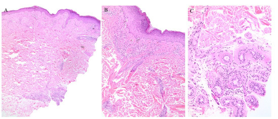 Lichen Striatus Histology