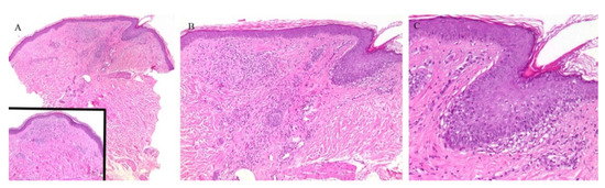 Adnexotropic Variants of the Interface Dermatitides: A Review
