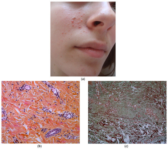 Ash Leaf Tuberous Sclerosis